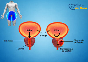 Câncer de próstata: sintomas, prevenção, tratamento – Clínica do Bem