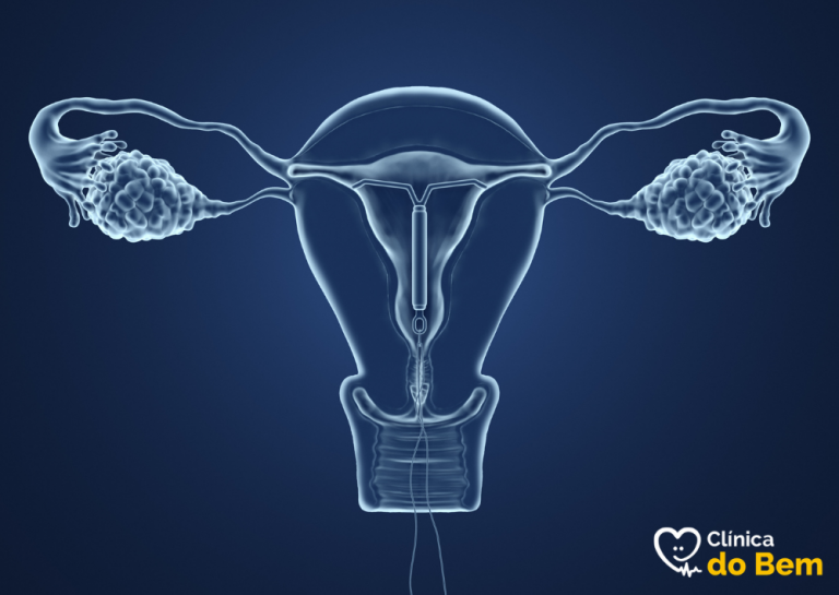 DIU: saiba como funciona e evita a gravidez – Clínica do Bem